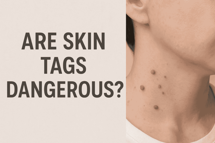 Are Skin Tags Dangerous? Why You Shouldn't Ignore Them